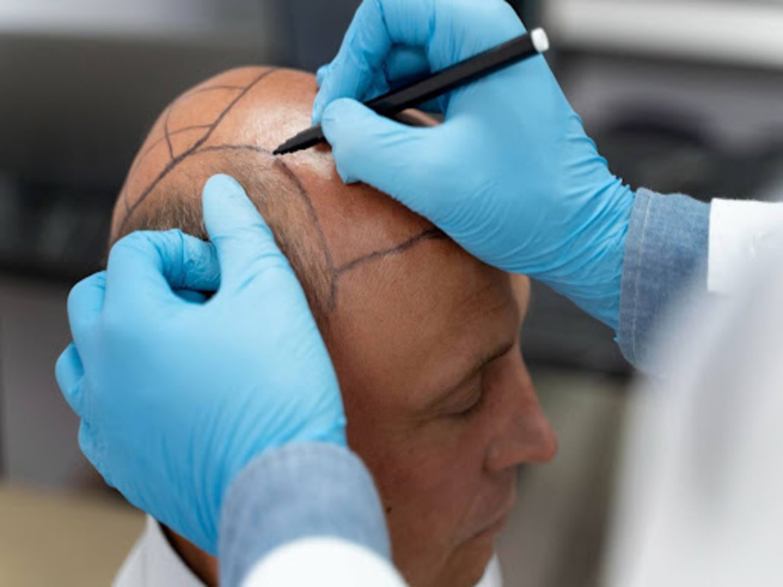 Mumbai’s Top Trichologists & Treatments | Revitaltrichology