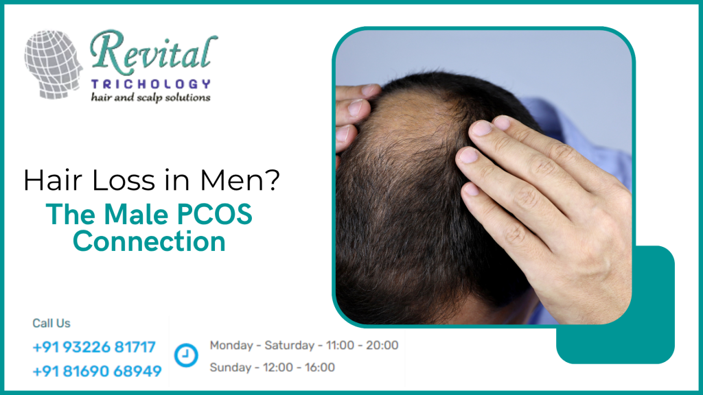 Unexplained Hair Loss in Men? Male PCOS Might Be the Cause